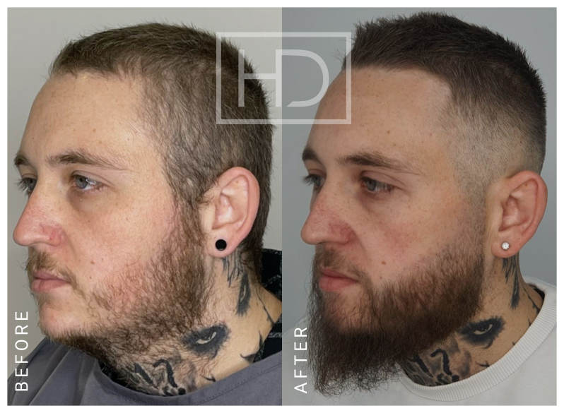 Beard Translpant - Hair Doctors